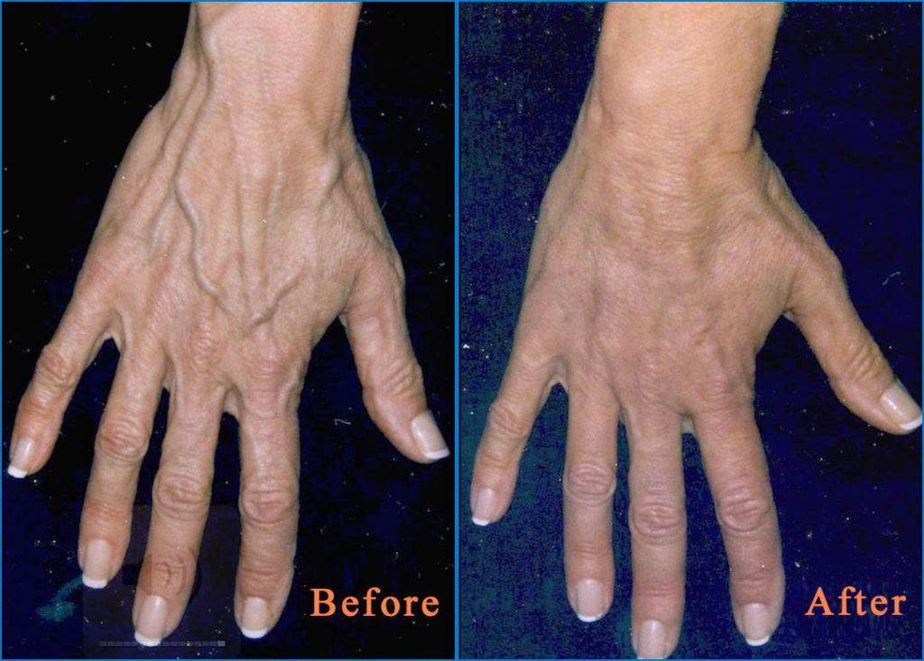 Videos - Dr. Gabriel Goren, M.D. | Hand Vein Surgeon