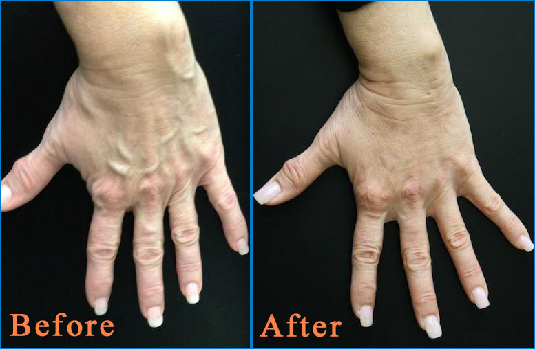 Compare Treatment Options for Bulging Hand Veins